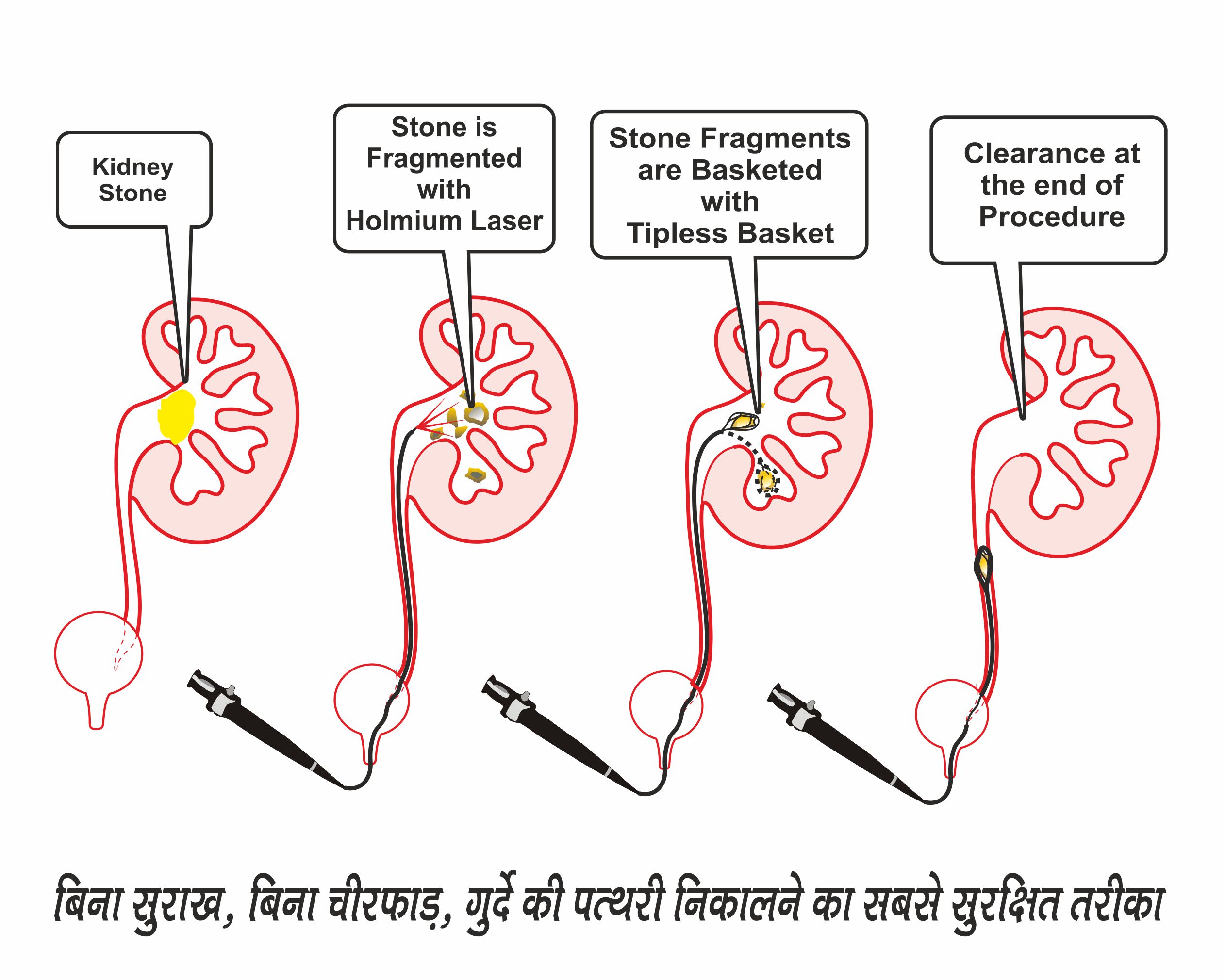 Kidney stone treatment